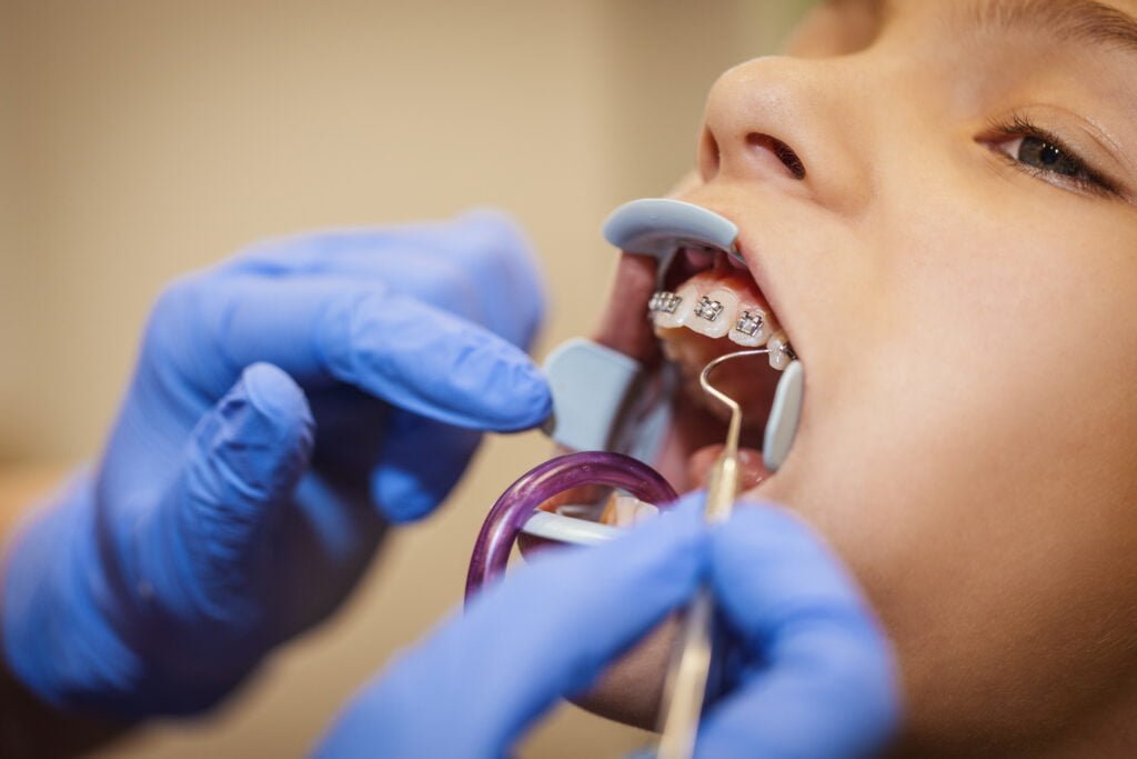 Beyond Braces: Early Intervention With Interceptive Orthodontics